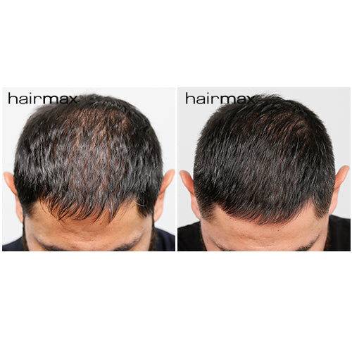 Hairmax RegrowMD 272 Laser Hair Growth Cap