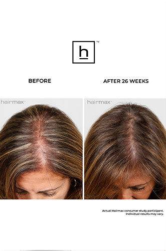 Hairmax Ultima 12 Hair Growth LaserComb