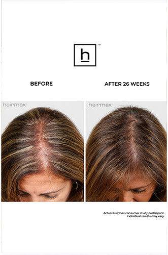 Hairmax RegrowMD 272 Laser Hair Growth Cap